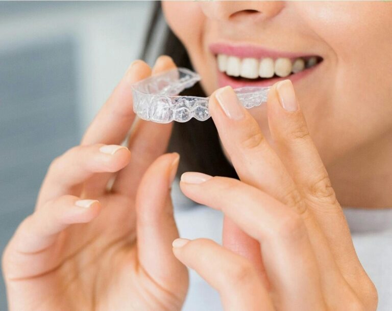 Why Retainers Are Essential After Braces